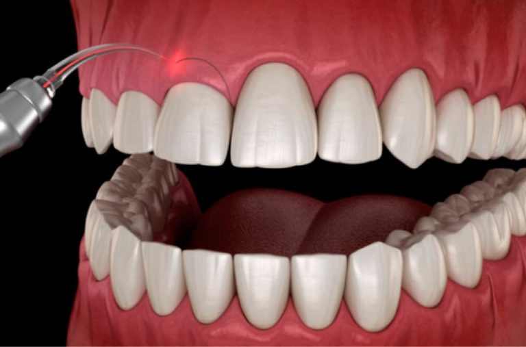 Tratamento da Gengiva (Periodontia) – CDS Odontologia Digital